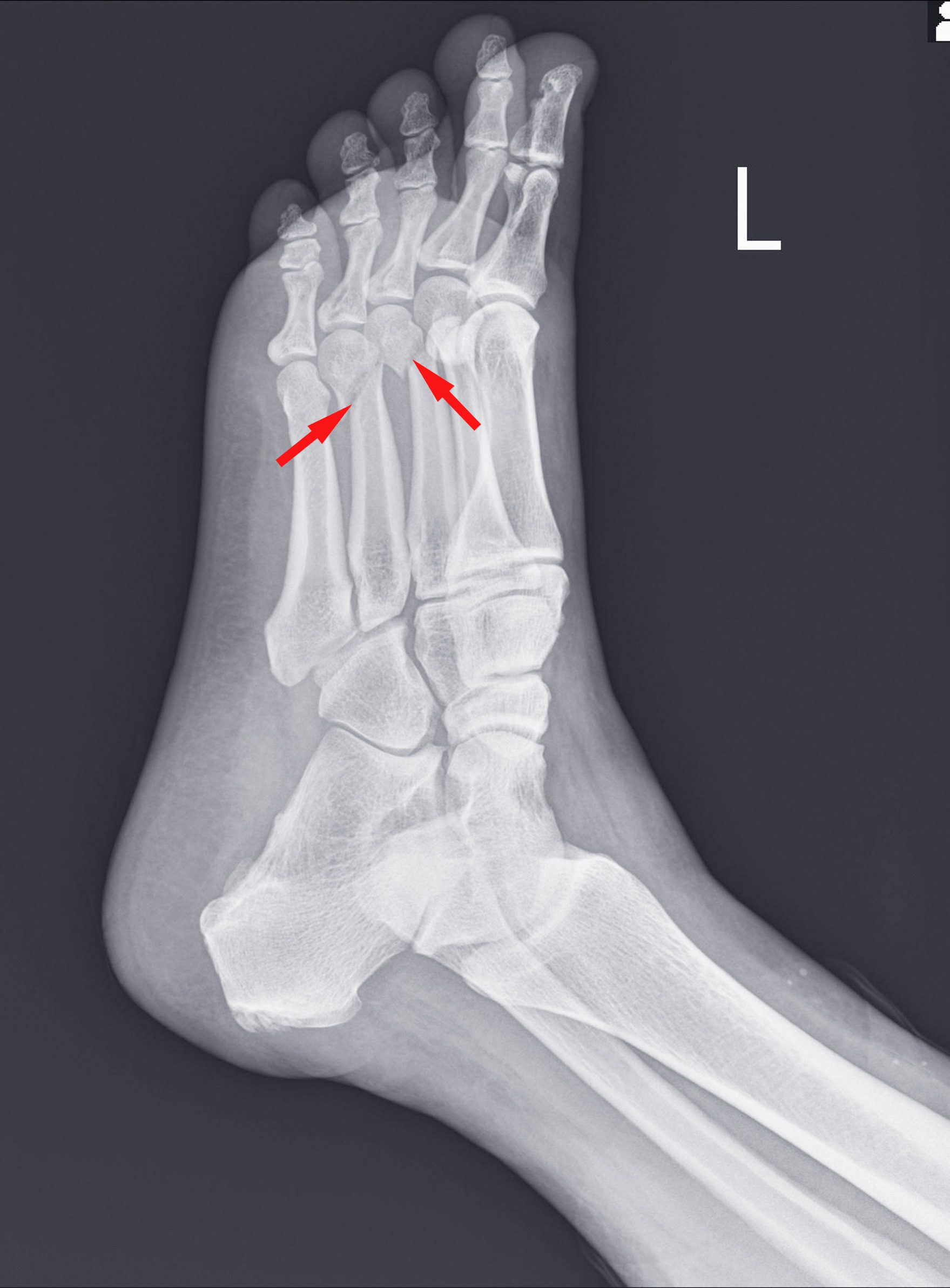 Toe Injury Compensation - How Much Can I Claim? - How To Sue