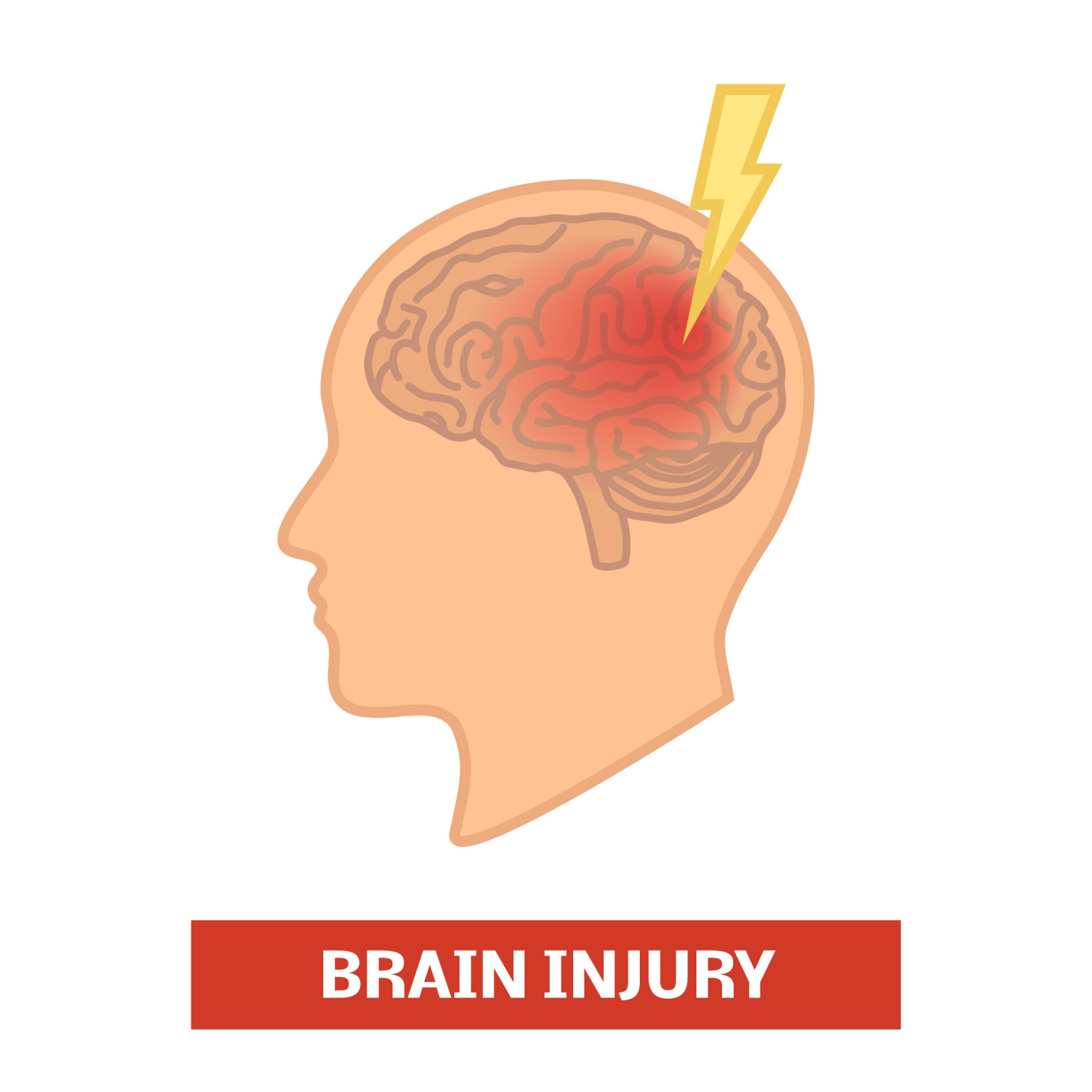 How To Sue For A Brain Injury - Claim Compensation